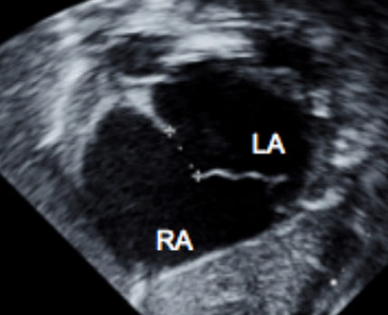 ASD Device Closure - Dr N Srinath Reddy - Pediatric Cardiologist