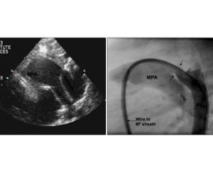 PDA Device Closure - Dr N Srinath Reddy - Pediatric Cardiologist