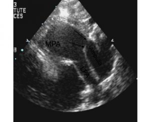 PDA Device Closure - Dr N Srinath Reddy - Pediatric Cardiologist